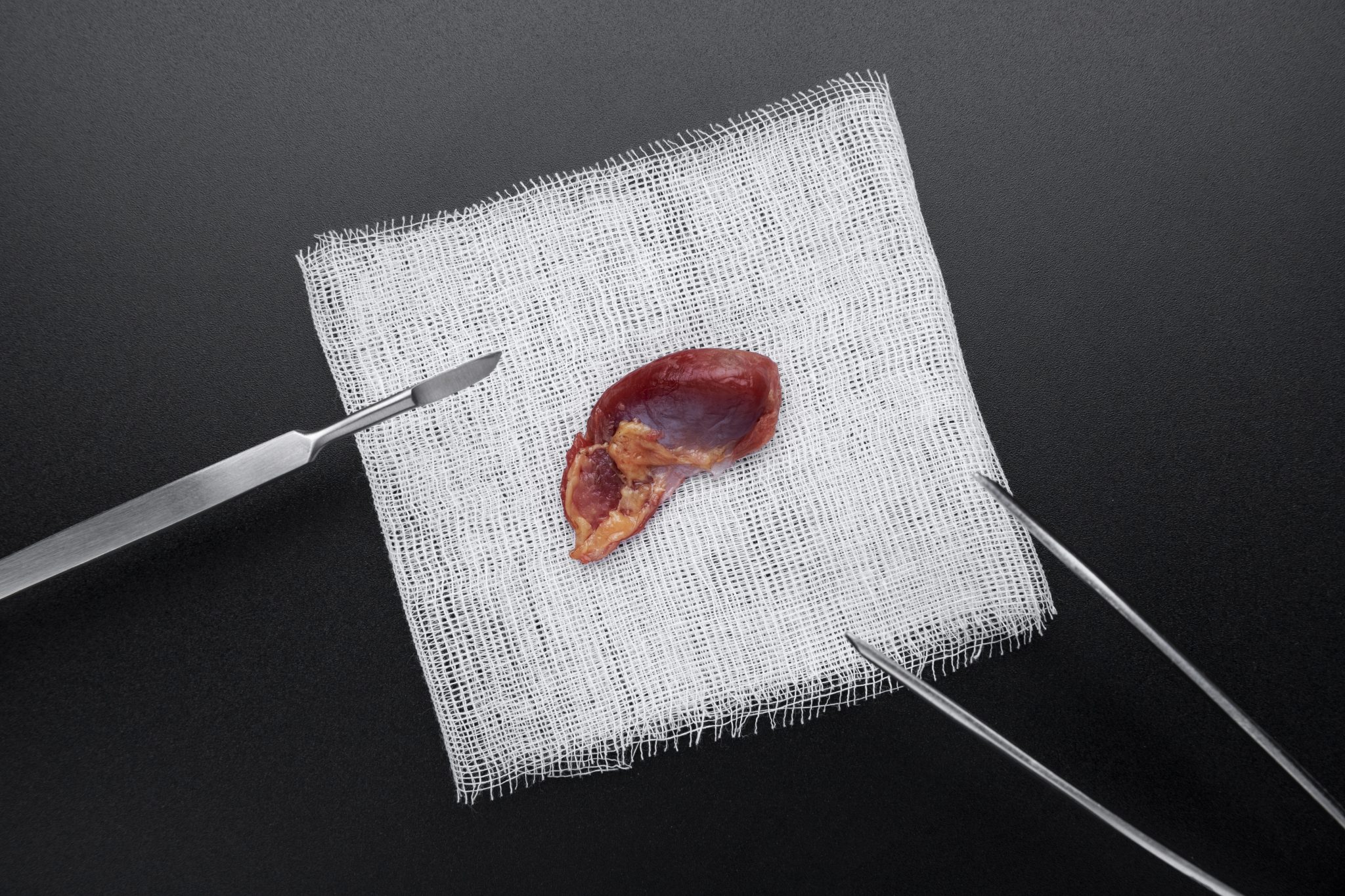 Hepatitis in Chickens